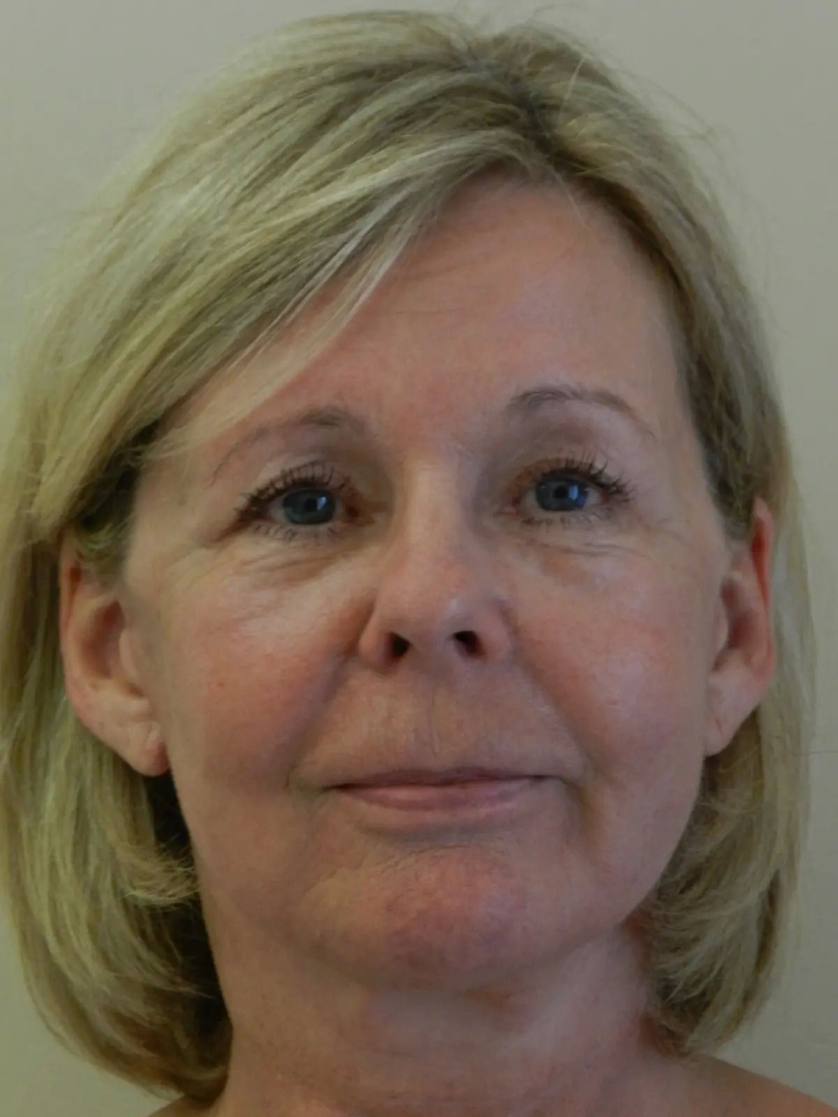 Facelift Fotos - Estheticon.de