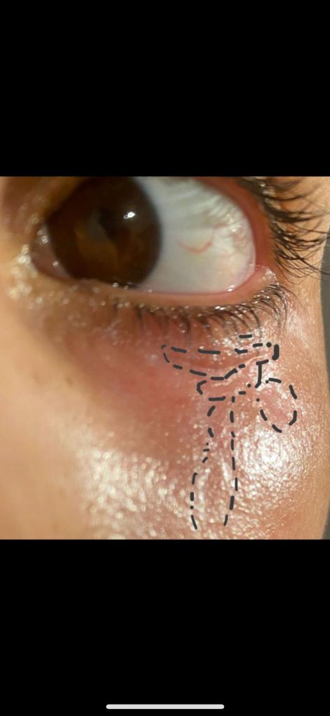 CO2 Laserung bei Malar Bags und Narben - Estheticon.de