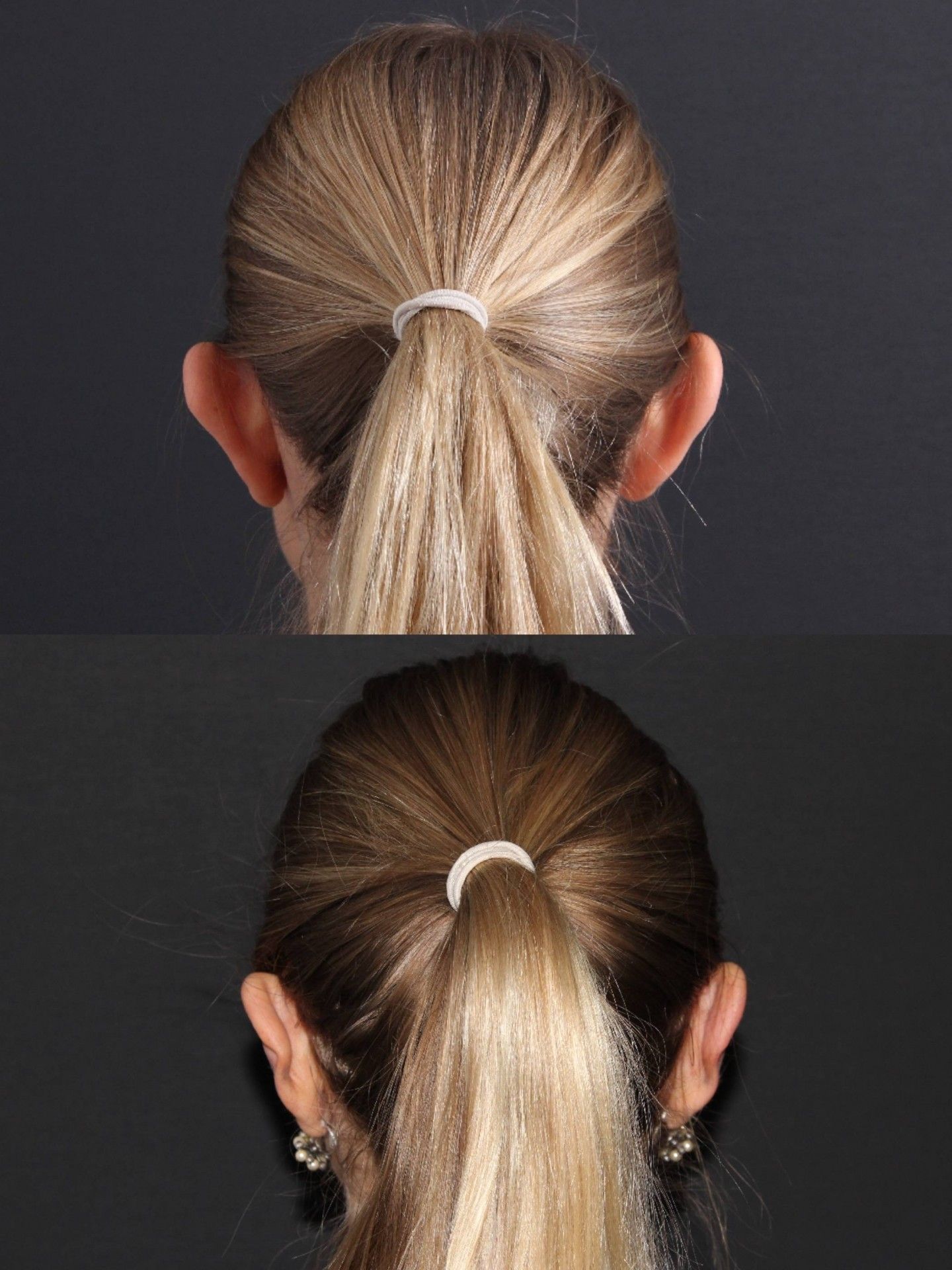 Ohrenkorrektur mit der Earfold™ Methode: sehr zufrieden - Estheticon.de