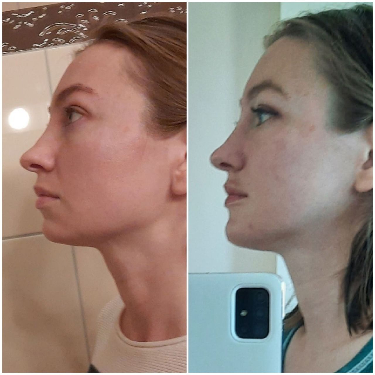 Kinnaufbau bei Dr. Suhr - Kinn ist Meisterwerk! - Estheticon.de