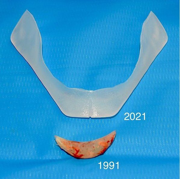 Suche Arzt für Custom (Maßangefertigt) Kinn-/Kiefer Implantat in ...