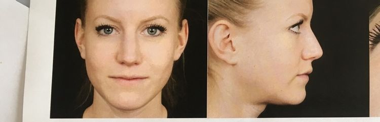 2. Nasenkorrektur nach Unfall als Kind - Estheticon.de