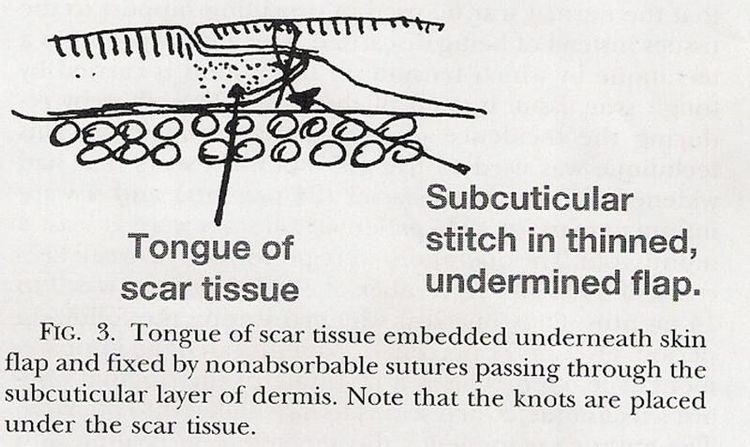 Entfernung der Narbe am Schienbein - Estheticon.de