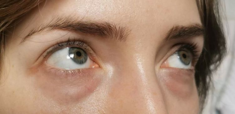 Behandlung bei dunklen Augenringen - Estheticon.de