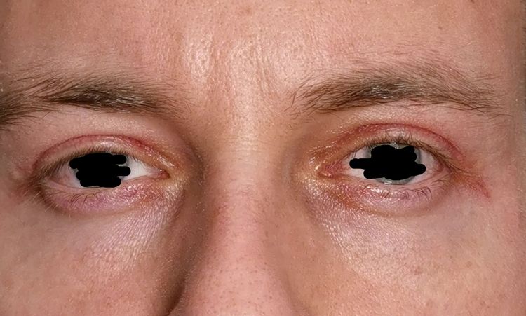 Rötung nach Augenlid-OP - Estheticon.de