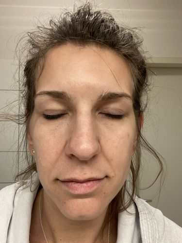 Narbe Oberlidstraffung - Estheticon.de