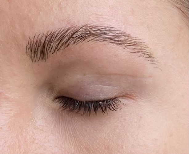 Atrophe, sichtbare Narben nach Augenlidkorrektur (über 1 Jahr her ...